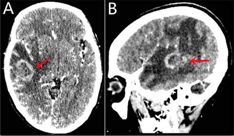 Brain Mri Showed An Irregular Mass In The Right Temporal Lobe With