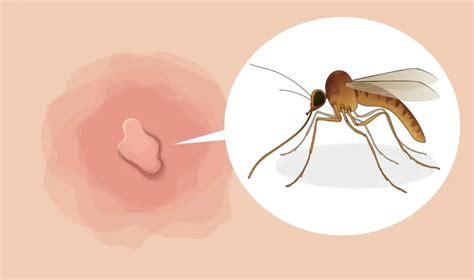 Summertime Biting Bugs First Aid Guide To Identify Bites And Stings