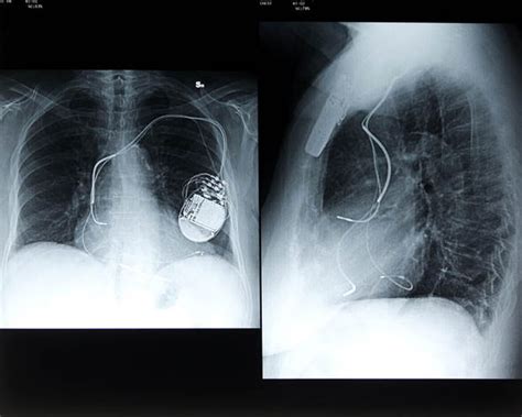 Anti Theft Systems Affect Pacemaker Patients By Causing Irregularities