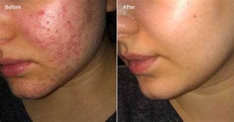 Topical And Oral Clindamycin For Acne Dosage Side Effects And More