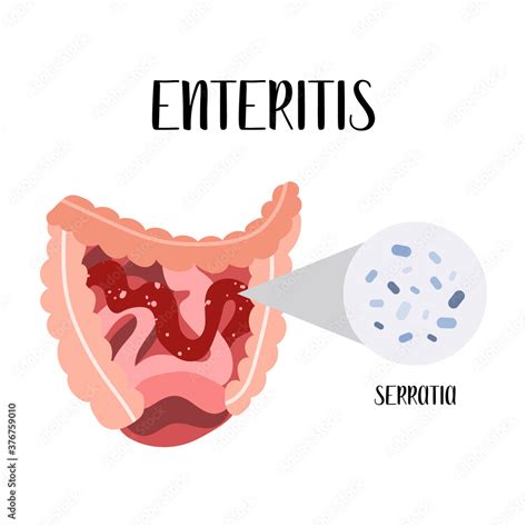 Enteritis Inflammation Of The Small Intestine Serratia Bacteria Gut