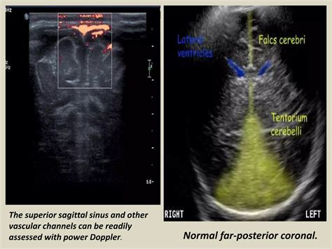 Presentation1 Pptx Ultrasound Examination Of The Neonatal Head Pptx