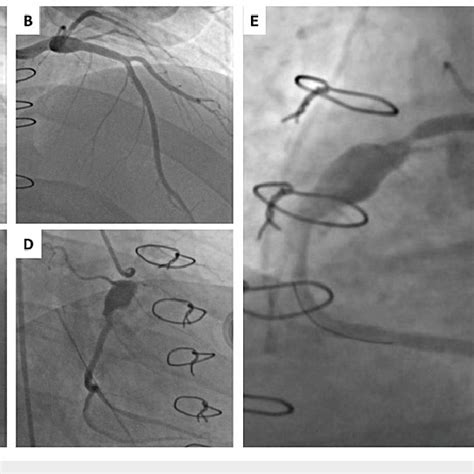 Coronary Angiogram Before And After Attempted Angioplasty With Cutting