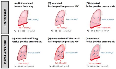 Ventilator Induced Lung Injury The Unseen Challenge In Acute