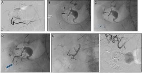 A New Innovation In Embolization Merit Medicals Microcatheter