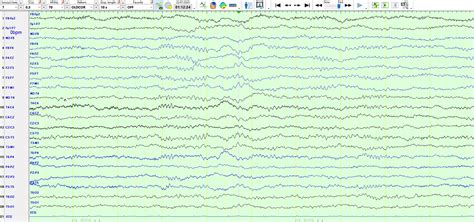 The Common Average Montage Left Temporal Sharp And Slow Wave