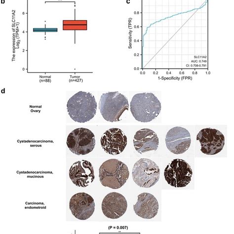 Relationship Between Slc11a2 And Ovarian Cancer Prognosis Cell