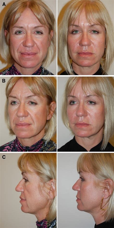 Frontal A Oblique B And Profile C Views Of The Patient In