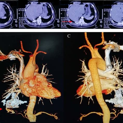 Avm Classification By Yakes Et Al 9 Download Scientific Diagram
