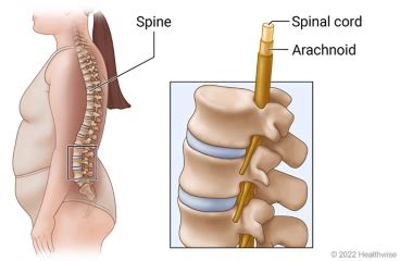 Arachnoiditis Kaiser Permanente