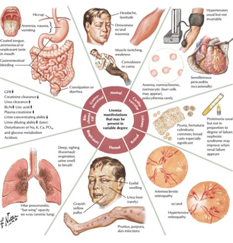 Renal Function Aki And Cdk Flashcards Quizlet
