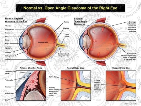 Glaucoma Eye Vs Normal Eye Cataracts And Glaucoma Glaucoma Nz