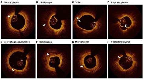 Representative Plaque Characteristics In Oct Images A Fibrous