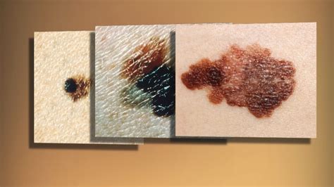 Dermatologists Show How To Spot And Identify 3 Types Of Skin Cancer