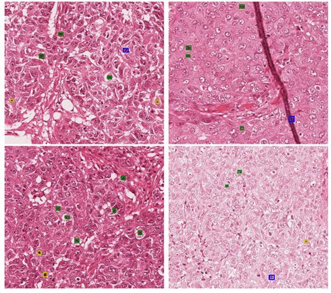 Mitosis Detection Results Of Deepdet Seg Ver On Four Hpfs Of The 2014