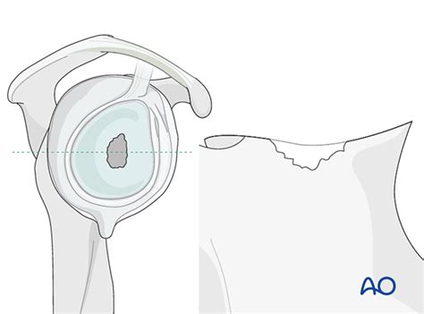 Revision Of An Anatomic All Polyethylene Glenoid Component For Glenoid