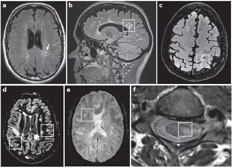 多发性硬化 中国医学影像联盟 China Medical Imaging Association
