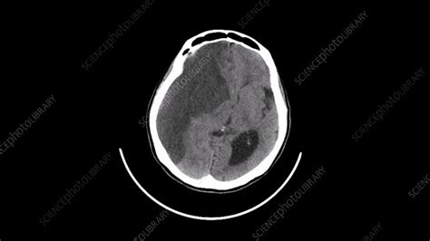 Embolic Stroke Ct Scan Stock Video Clip K0111451 Science Photo