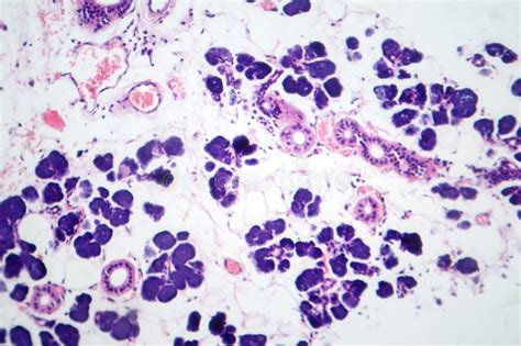 Mixed Parotid Tumor Photomicrograph Showing Epithelial And
