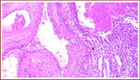 Germ Cell Tumor Teratoma And Embrionary Carcinoma Components