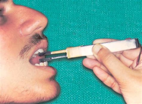 Technique For Recordings The Maximum Bite Force Mbfp2 Download Scientific Diagram