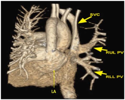 Anomalous Right Upper Pulmonary Vein Draining Into The Svc La