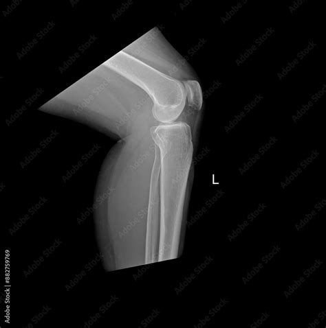 Knee X Rays For Diagnostic Purposes Meniscus Tear Bilateral Knee