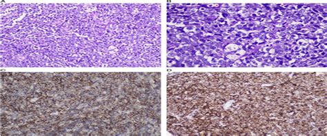 Plasmablastic Lymphoma In A Human Immunodeficiency Virus Pos