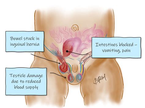 Testicular Hernia Inguinal Hernia Repair By Dr David W Ford