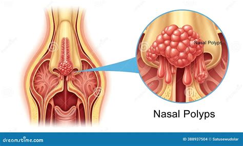 Nasal Polyps Noncancerous Growths On The Lining Of The Nose Or Sinuses