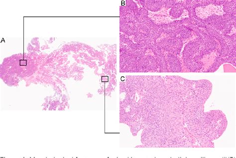 Exophytic Papilloma Of Bladder