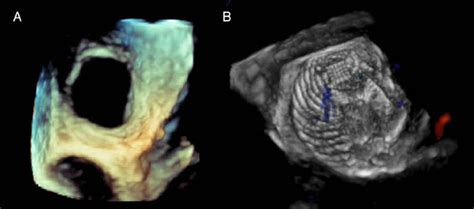 3d Transesophageal Echocardiography Visualization Of Atrial Septal