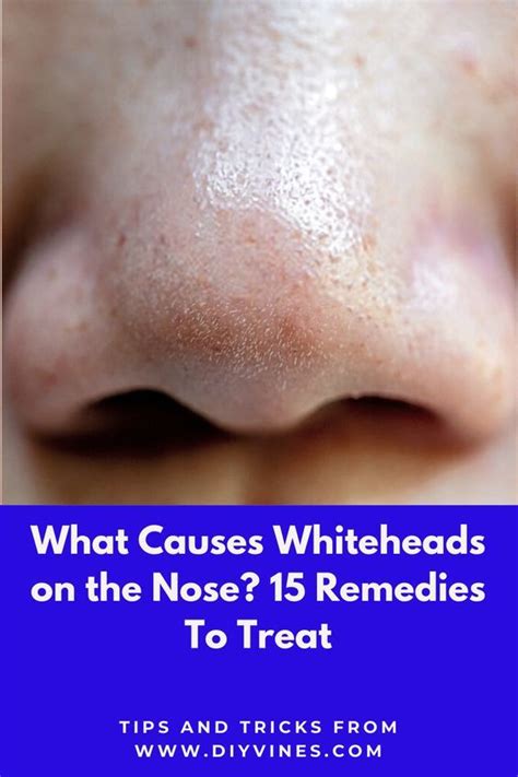 What Causes Whiteheads On The Nose 15 Remedies To Treat Artofit