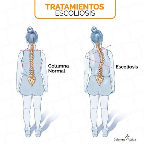 La Escoliosis Es La Curvatura De La Columna Vertebral En Forma De C O
