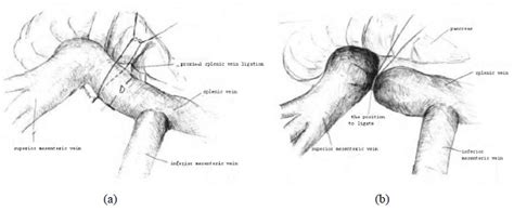 The Application Of Proximal Splenic Vein Ligation To Prevent Portal