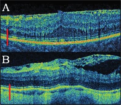 Ilm Removal As A Prophylaxis Of Erm Formation After Vitrectomy