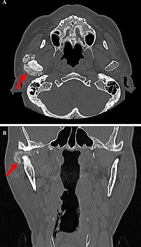 Preoperative Ct Images A Axial Ct Image Showing Large Intra Articular