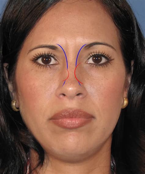 Spreader Grafting In Rhinoplasty San Diego Nose Specialist Dr Hilinski