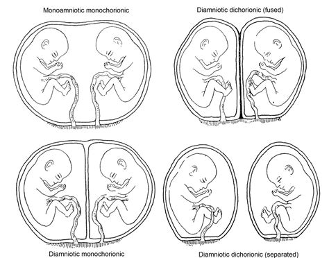Twin Pregnancy Types Of Twins Twins In The Womb Fraternal Twins