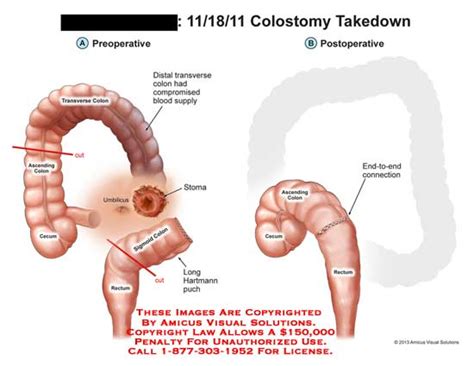 Colostomy Takedown