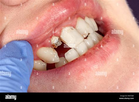 Human Tooth Close Up During Treatment And Prosthetics With Metal