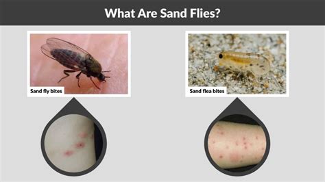 Sand Fly Bites On Humans Symptoms Pictures And Treatment