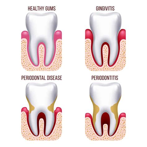 The Causes Of Periodontal Disease Huntingdon Valley Dental Arts