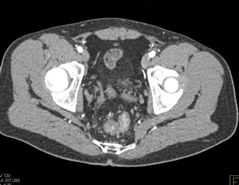 Proctitis With Rectal Varices Colon Radiology Case Studies Ctisus