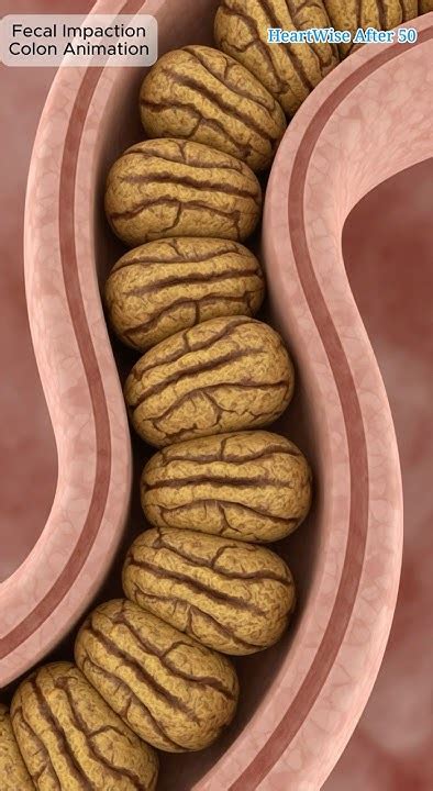 3d Animation Of Fecal Impaction Showing Severe Constipation Inside