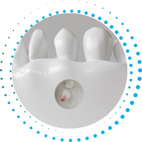 Root Canal Therapy Kearney Ne Grand Island Ne Heartland Oral