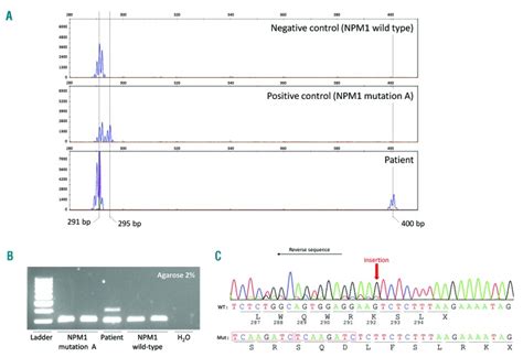 A Novel Type Of Npm1 Mutation Characterized By Multiple Internal Tandem Repeats In A Case Of