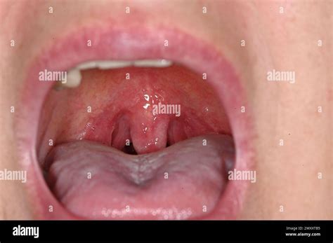 Tonsillitis Due To In The Throat Of A 61 Year Old Female Patient