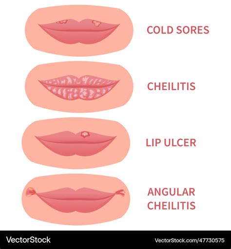 Mouth Disease Medical Set Of Sore Lips Icons Vector Image