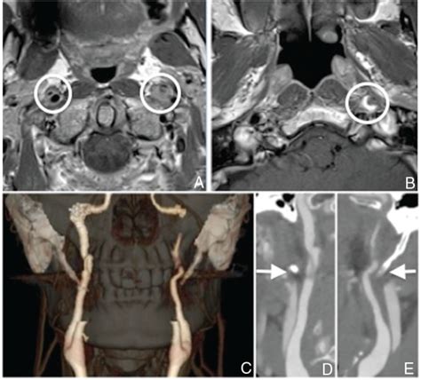 Carotid Artery Dissection Caused By An Elongated Styloid Process Three